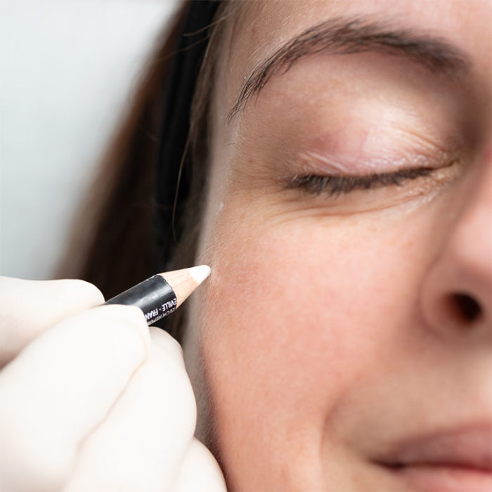 Traitement des cernes par injections d'acide hyaluronique à Niort